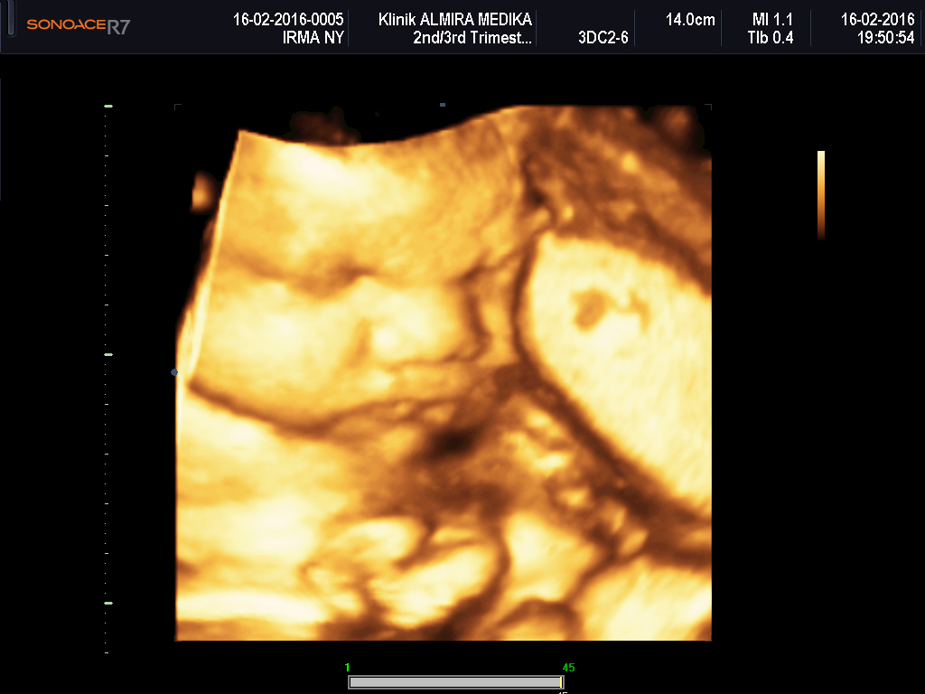 ALMIRA MEDIKA: USG 4D SURABAYA - SIDOARJO