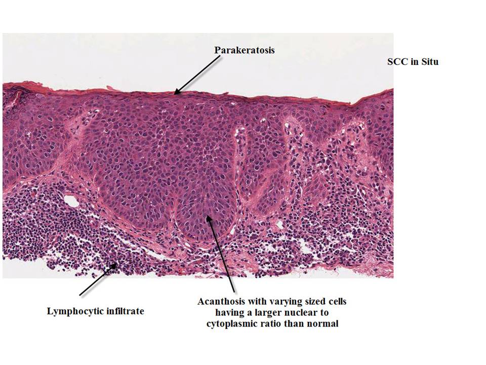 Dermpath Made Simple - Neoplastic: Squamous cell Carcinoma
