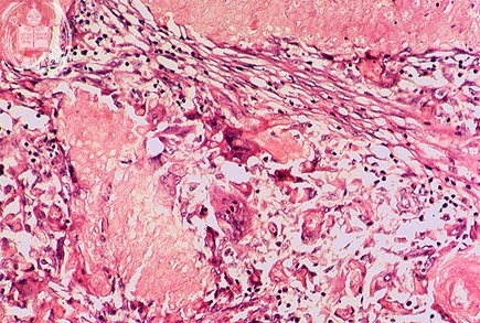 Agustina Ocampo - Patología B 2014: Epitelioma calcificante de Malherbe ...