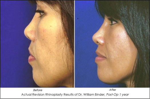 How To Obtain The Perfect Nose After A Failed Rhinoplasty ...