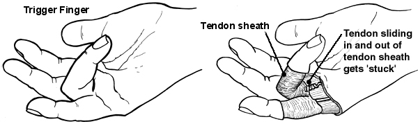 Massage La Mesa: TRIGGER FINGER. DOES KINESIOLOGY TAPE HELP?