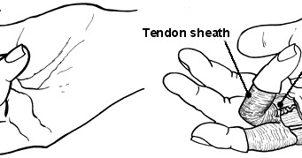 Massage La Mesa: TRIGGER FINGER. DOES KINESIOLOGY TAPE HELP?