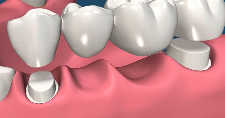 Que es y como se hace un puente dental | Odontología al Dia