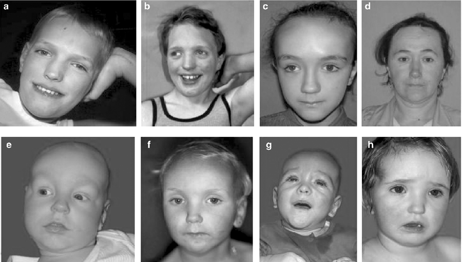 GEDR: Síndrome de Sotos