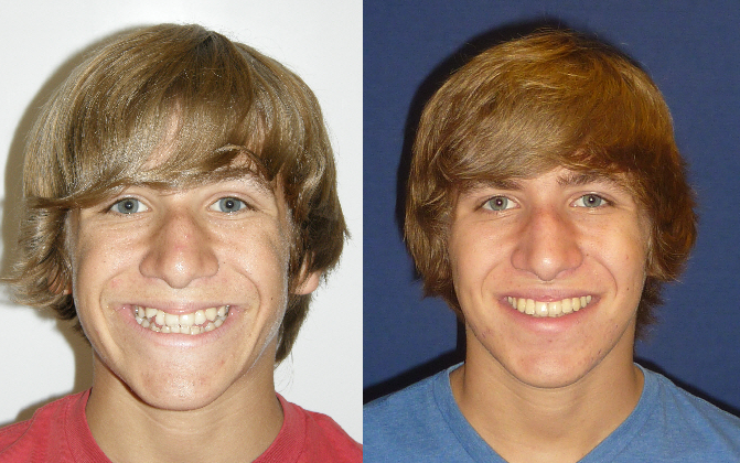 The Blog of Drs. Simon, Haerian, & Ludwig: Open Bite? Case Closed!