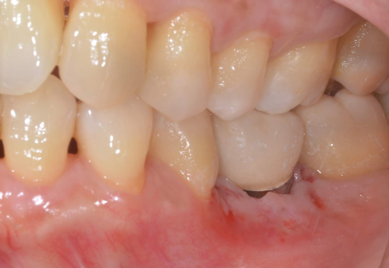 Carl Conley: CT graft to help the Peri-Implant Infection site