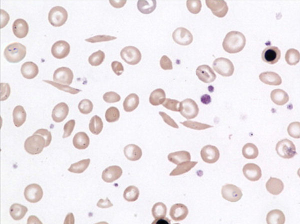 Medical Laboratory and Biomedical Science: Red Blood Cell Morphology Case