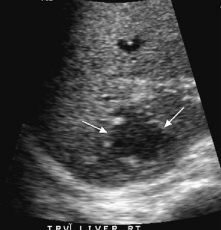 Liver abscess Ultrasound - Radiology Imaging