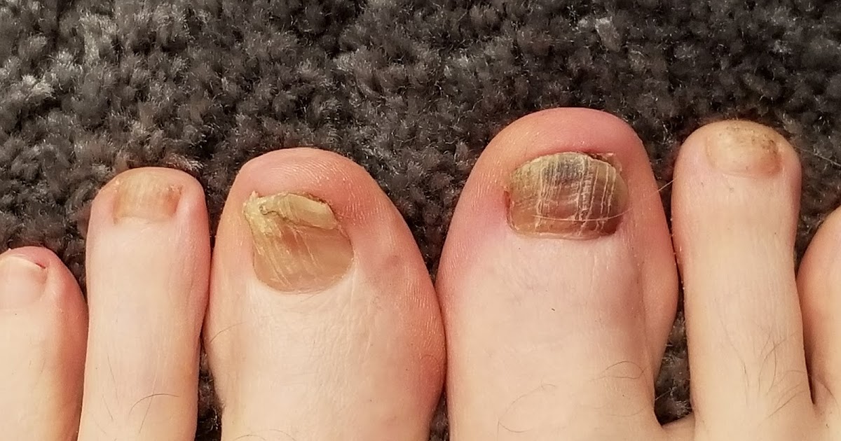 Run with Perseverance: A Tale of Two Toenails; How to Fix Runner's Toenails