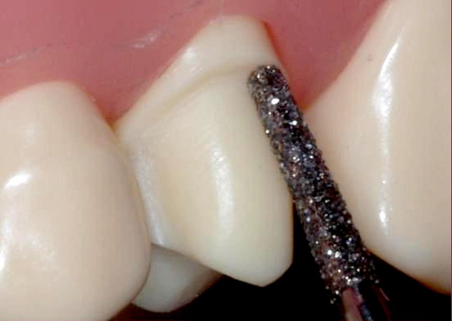 PDF: General principles for complete crown preparations - Odontología ...