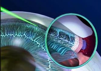 GLAUCOMA SPECIALIST BLOG: "THE GLOG": May 2018