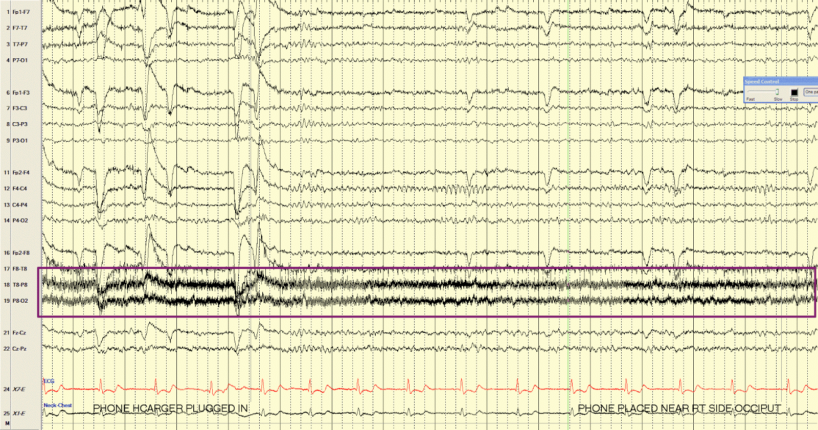 The Neurocritic: Newly Discovered EEG Rhythm Related to Texting, or ...