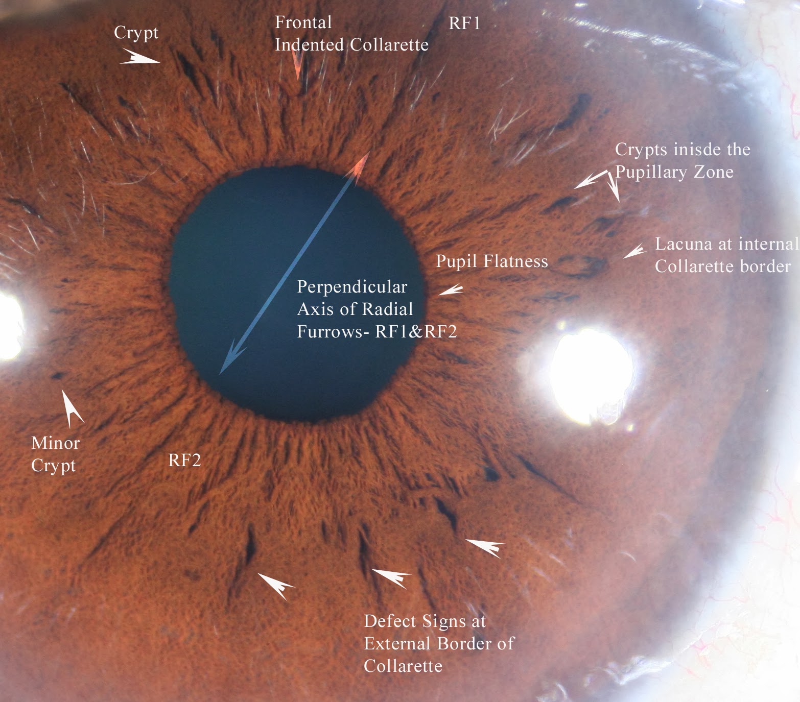 Modern & Multidimensional Iridology: Crypt, Defect Sign & Lacuna ...