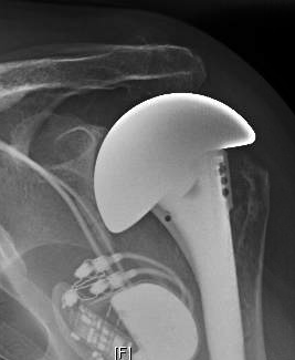 Shoulder Arthritis / Rotator Cuff Tears / Shoulder Pain : Cuff tear ...