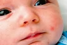 Cara Sembuhkan Ruam Susu Pada Bayi | Obat Herbal Murah