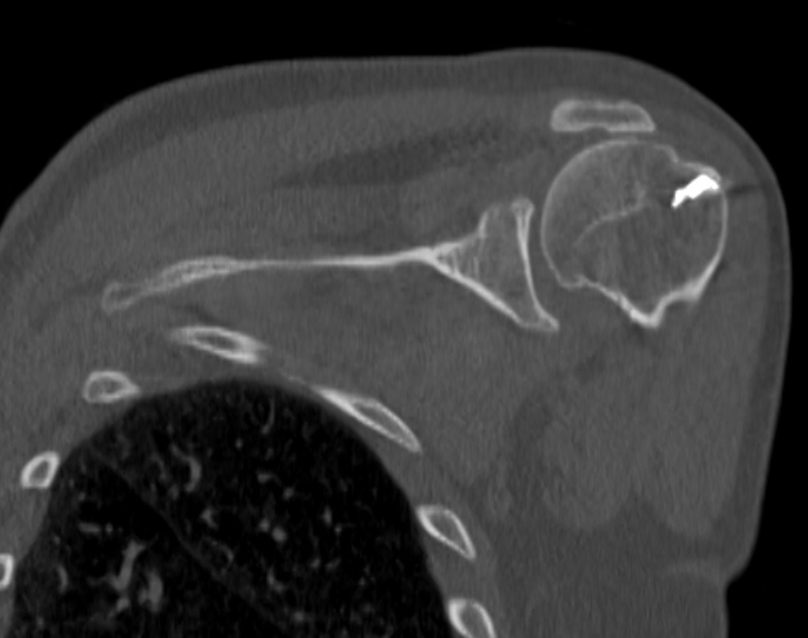 Shoulder and Elbow Surgery: Reverse shoulder replacement for ...