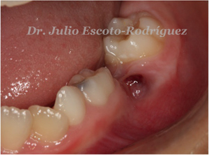 Casos de Cirugía Bucal y Maxilofacial : Caso No.20: Fístula Facial por ...