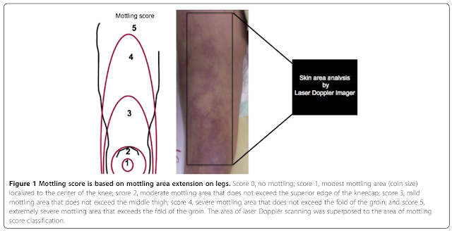 Hospitalist ~なんでも無い科医の勉強ノート~: 末梢循環不全の評価: MottlingとCRT