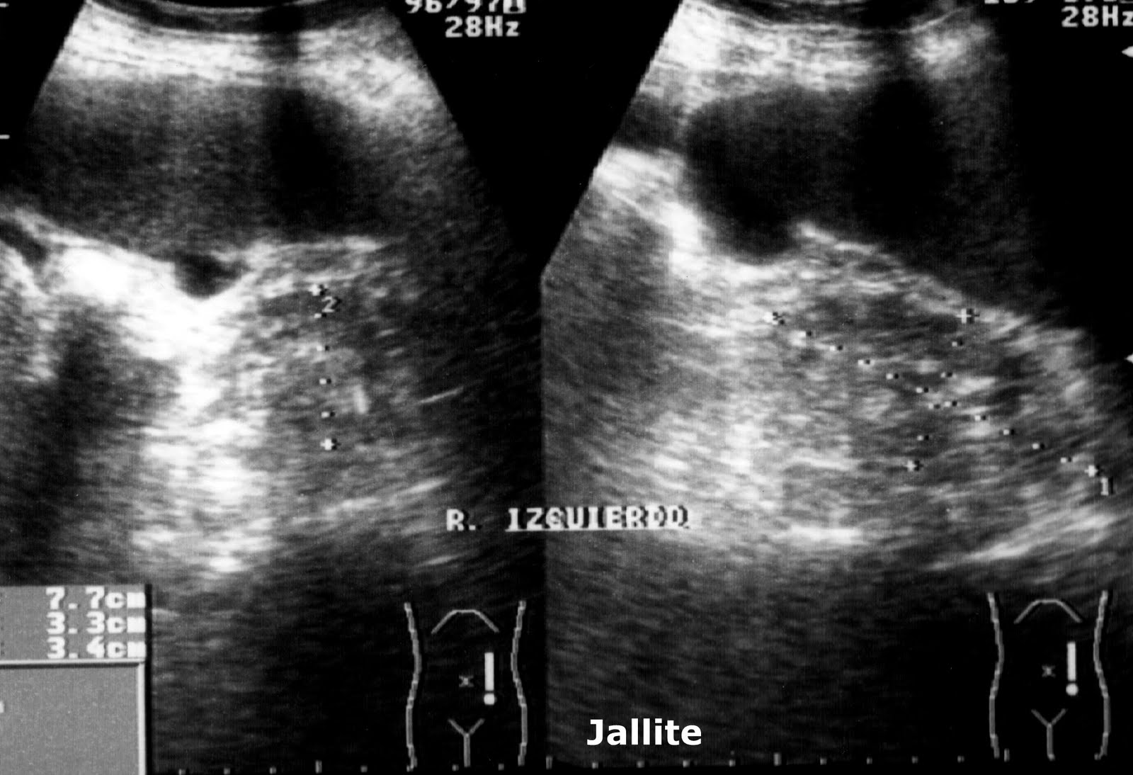 Hernia Umbilical y......