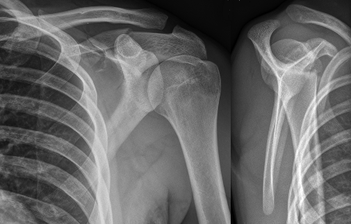 Estudo Radiográfico : ROTINA DE ESCÁPULA
