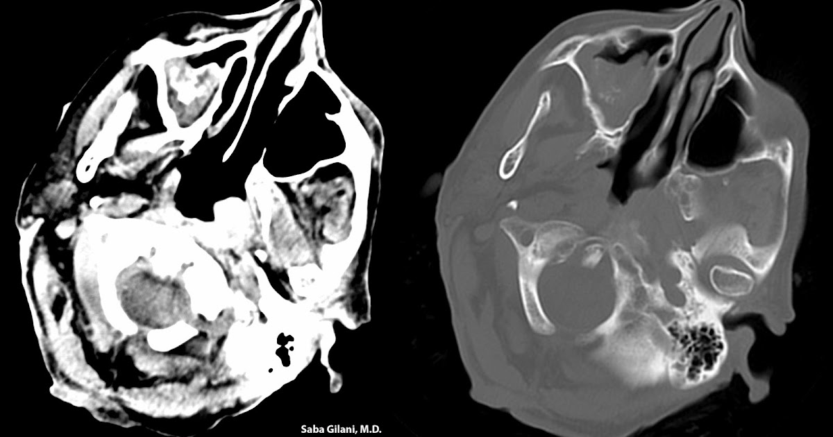 Roentgen Ray Reader Mycetoma Formation In Fungal Sinusitis
