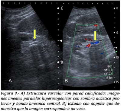 Madrid Urología: Microlitiasis Renal. Patología litiásica.