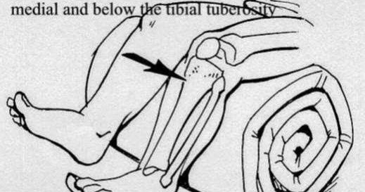 Medical & Beyond: INTRAOSSEOUS ACCESS