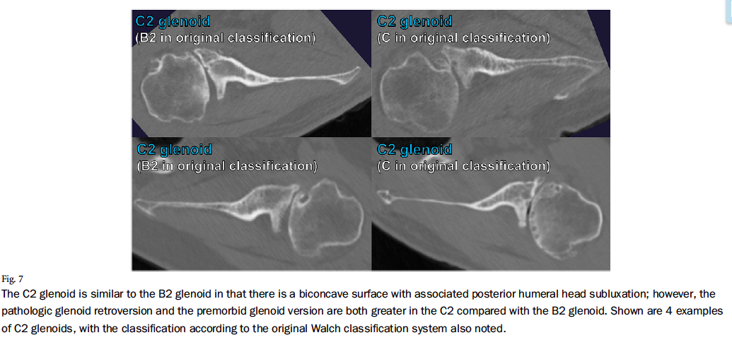 UW Shoulder and Elbow Academy: Shoulder arthritis - how may 'glenoid ...