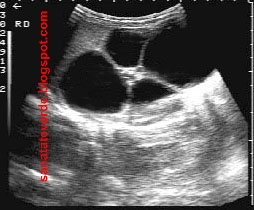 ecografie imagini medicina renal Renal nativ Hidronefroza | Terapii ...