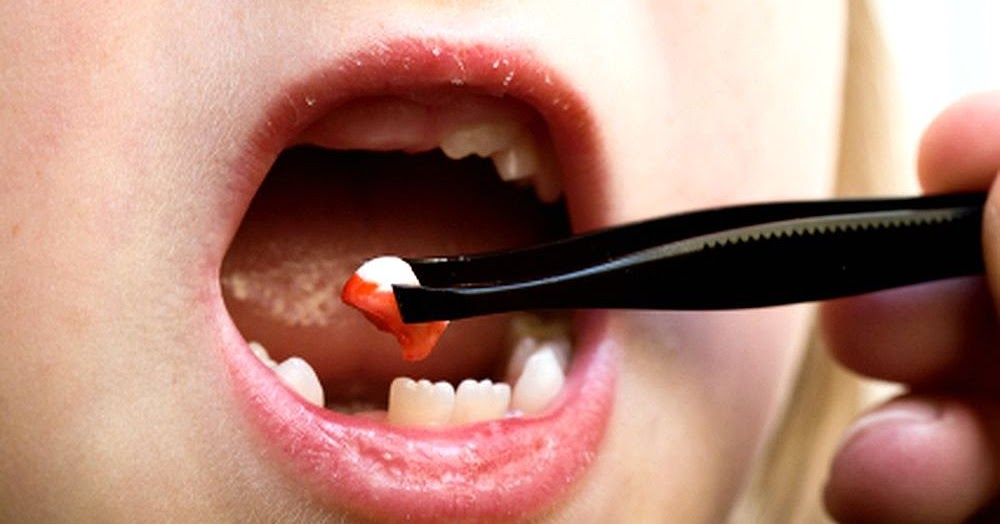 DENTAL EMERGENCY : Primary Tooth Injury and Emergency Extraction ...