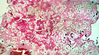 DESTINO MEDICO: MICROSCOPIO VIRTUAL, PATOLOGIA CARDIACA - MIXOMA