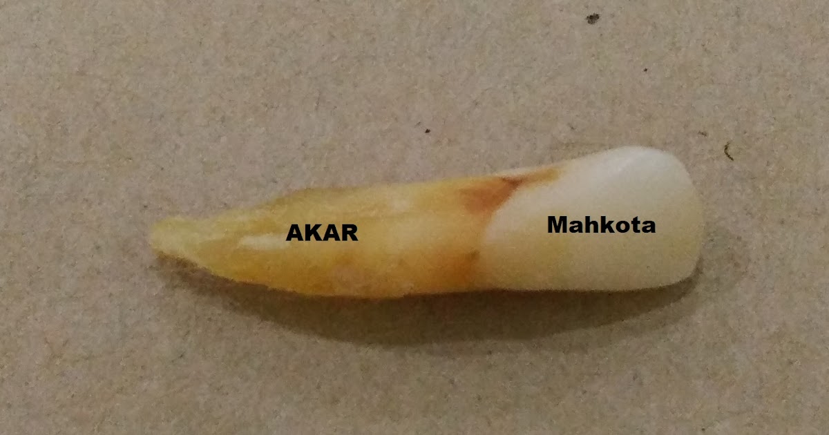 Catatan Kecil Petugas Pemberi Layanan Klinis: Avulsi gigi, Penyebab dan ...