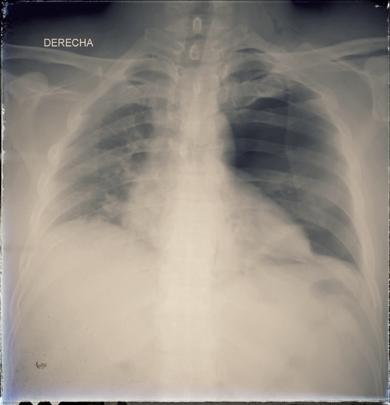 Radiologia Medica: Neumotórax por placa simple de tórax