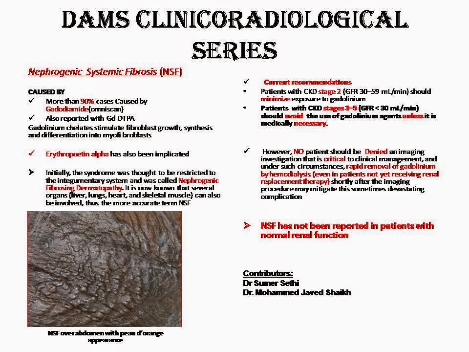 Nephrogenic Systemic Fibrosis : Clinicoradiological Series - Sumer's ...