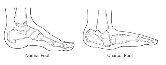 傷口大師: Charcot Foot（夏兒哥足）
