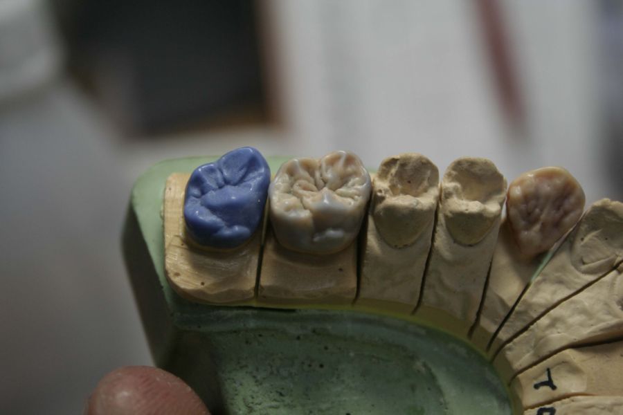 Dental2804: 7.wax up / made by 신관하