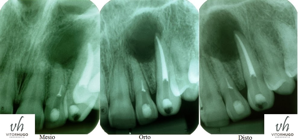 VH Endodontia: Apicectomia com instrumentação e obturação do canal ...
