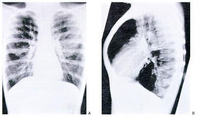 Taysir assistance الإسعاف الطبي تيسير: Crise d'asthme aigu grave chez ...