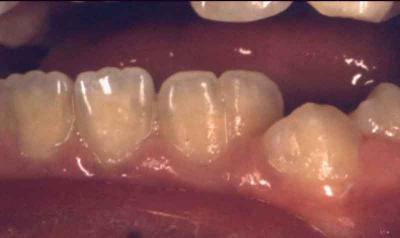 rayosxmaxilofacial: Geminación Dentaria