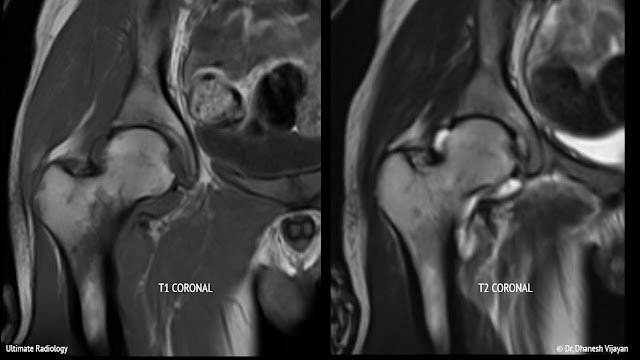 Ultimate Radiology : Septic arthritis of hip joint