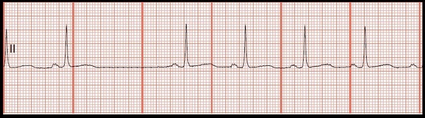Practice EKG Strips 403