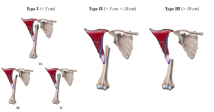 Shoulder Arthritis / Rotator Cuff Tears / Shoulder Pain : Reverse ...