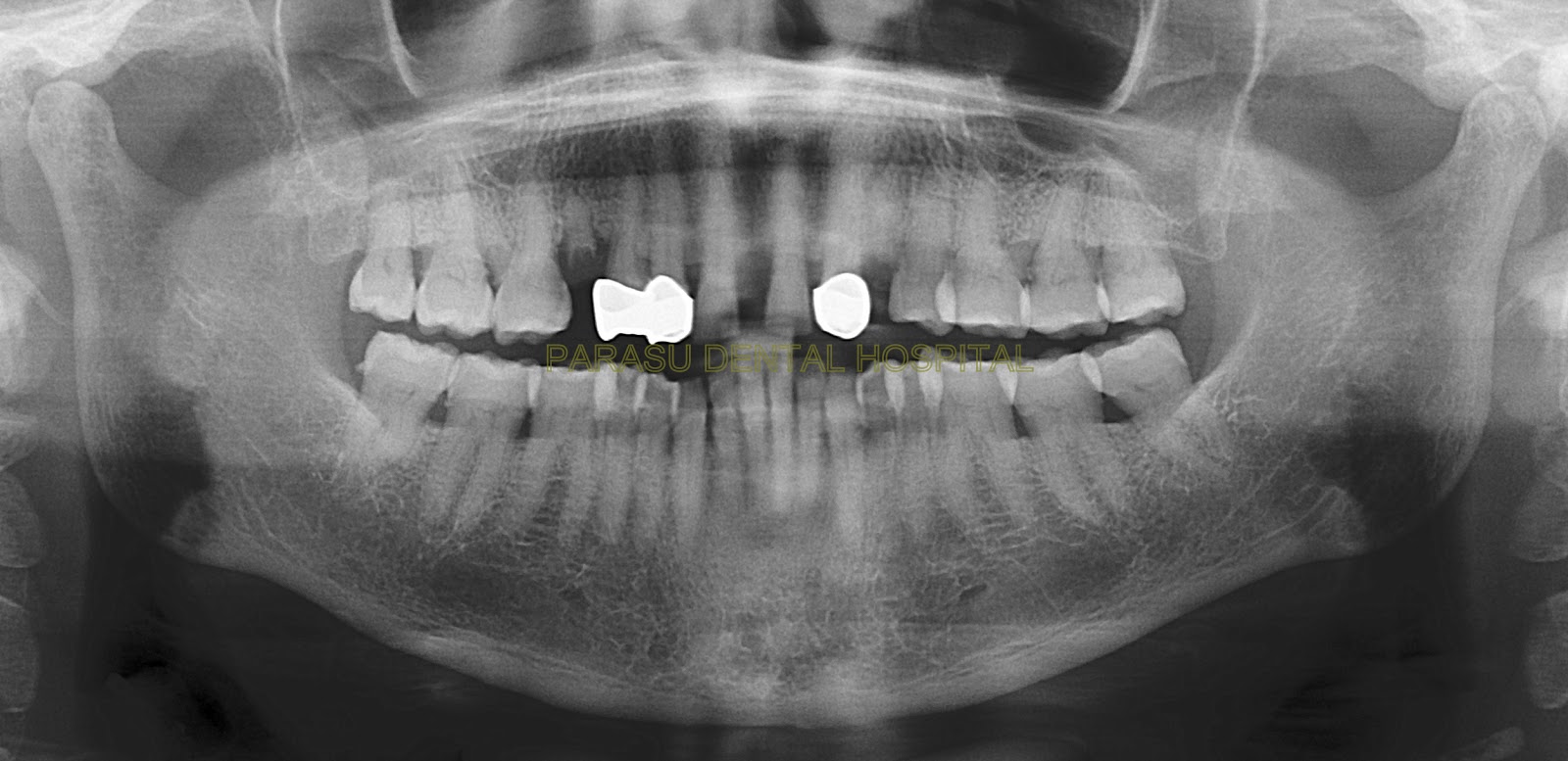 Dental Xray center in medavakkam: Dental Implants in Chennai | Best ...