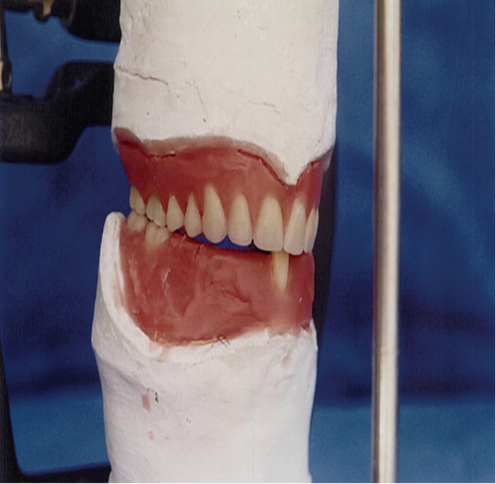 Prostodoncia total: Definición y conceptos de Prostodoncia Total