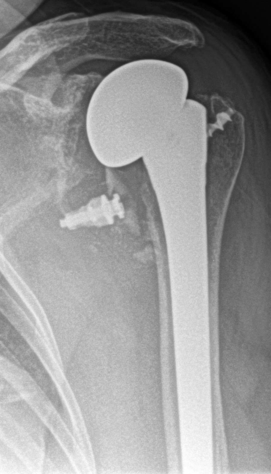UW Shoulder and Elbow Academy: Failure of anatomic total shoulder joint ...