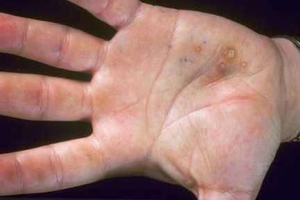 Photos of Warts on Hands and Fingers ~ How To Remove Moles, Warts, Skin ...
