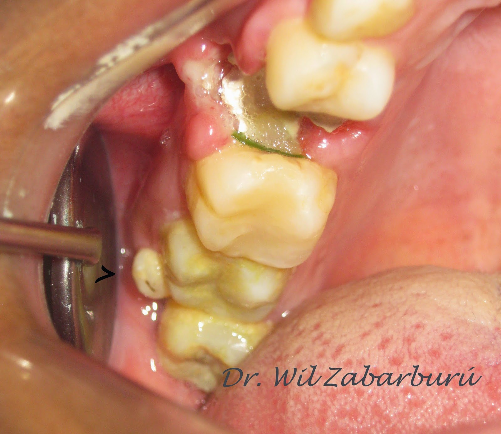 CLINICA DENTAL ASISTENCIAL: PARAMOLAR