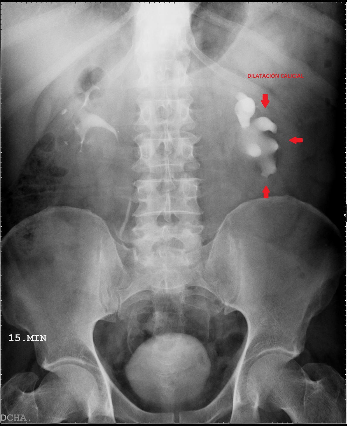 Anatomía Radiológica de Pelvis y Abdomen: Riñones. Vía urinaria: