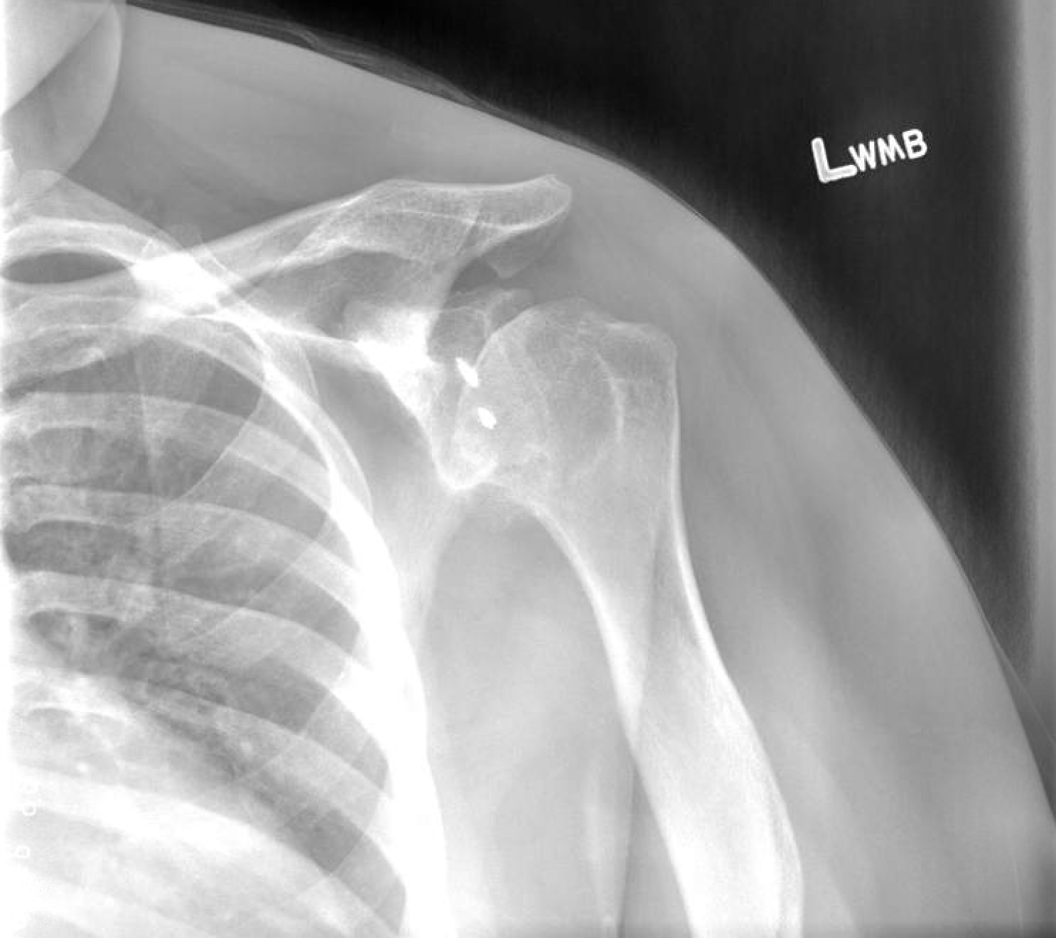 Shoulder and Elbow Surgery: Iliac crest bone grafting of the glenoid to ...