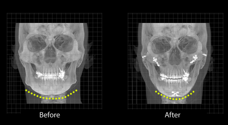 Perbedaan antara operasi dua rahang dan rahang? Operasi apa yang cocok ...